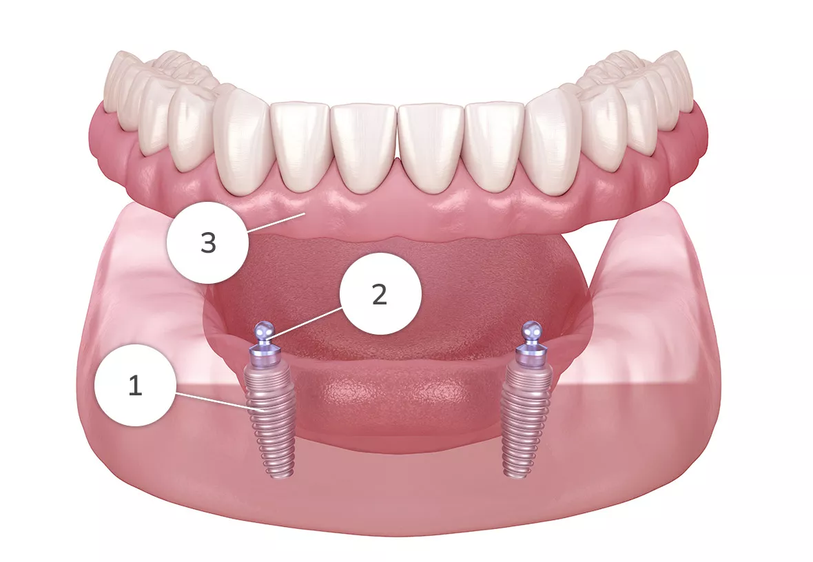 Implant-supported dentures in Danforth | Dr. Berzin Dental Implants